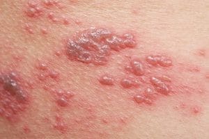 O que é cobreiro? Como se manifesta? Saiba o melhor remédio caseiro!