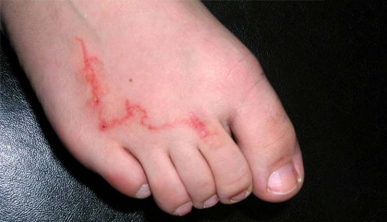 O que é cobreiro? Como se manifesta? Saiba o melhor remédio caseiro!